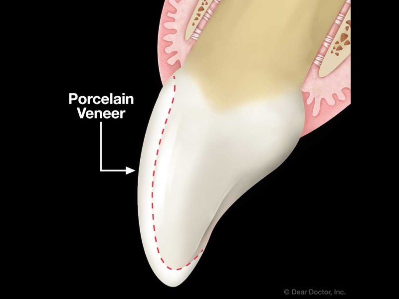 Getting Veneers from Panoramic Dental | Walnut Creek, CA